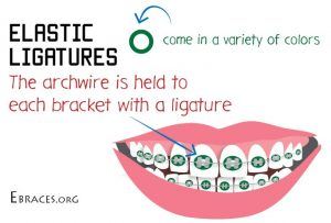 Everything You Need to Know About Rubber Bands for Braces