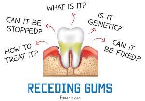 How to Prevent, Stop and Even Reverse Receding Gums